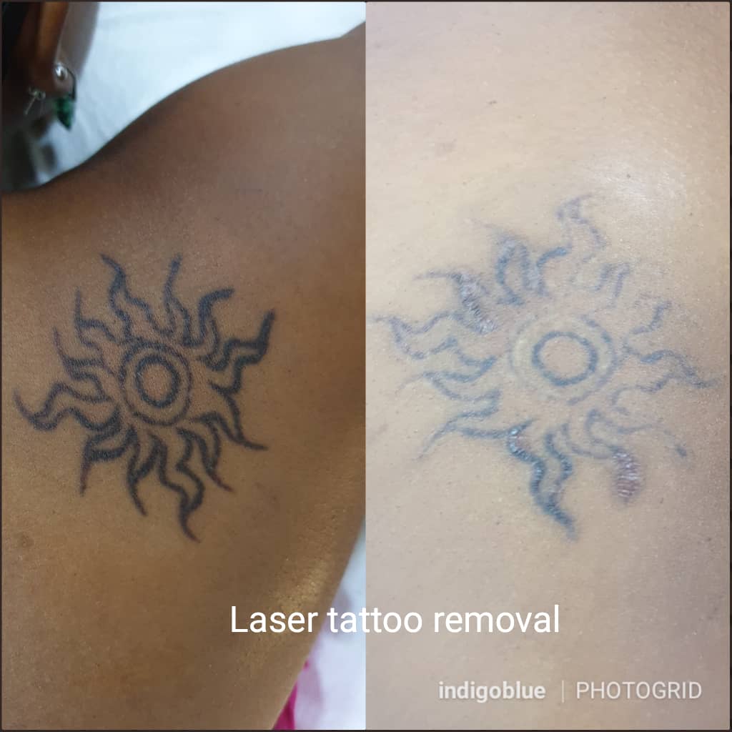 Laser Procedure – Indigo Medical Aesthetics lekki lagos abuja nigeria